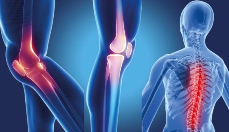 Osteopeni (Düşük kemik yoğunluğu) nedir ve belirtileri nelerdir ...